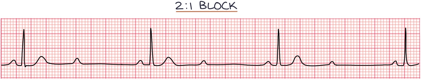 Arrhythmias – Zero To Finals