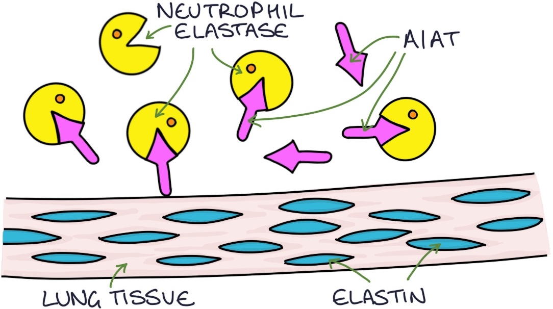 Alpha-1 Antitrypsin Deficiency – Zero To Finals