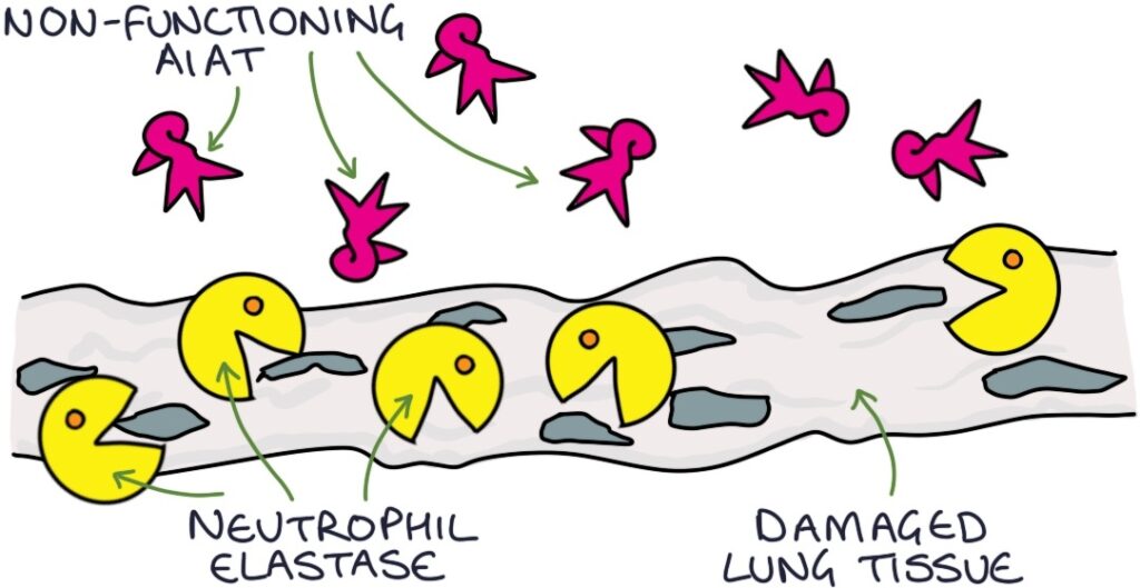 Alpha-1 Antitrypsin Deficiency – Zero To Finals