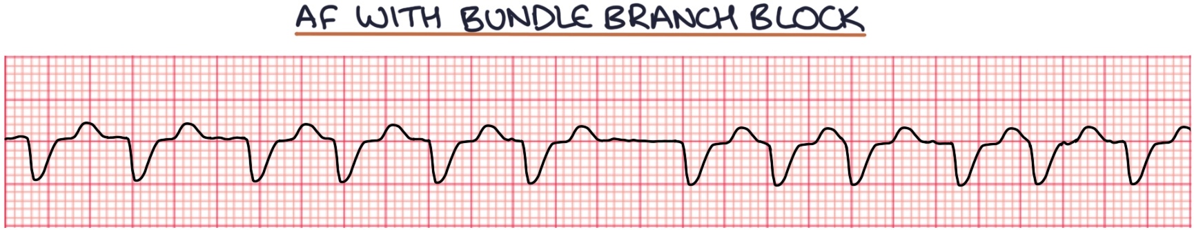 Arrhythmias – Zero To Finals