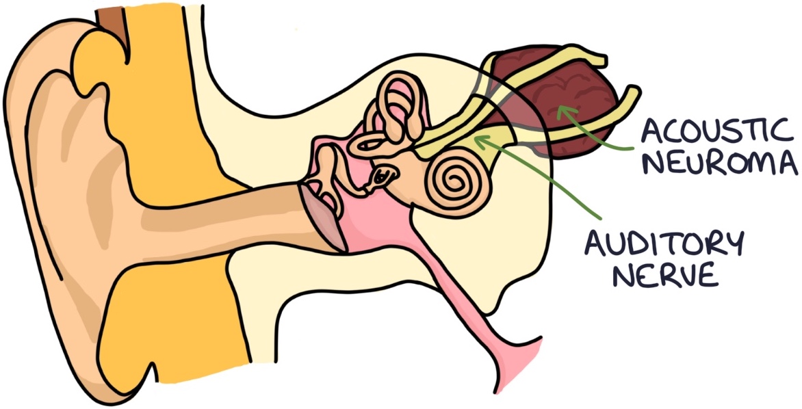 Acoustic Neuroma – Zero To Finals