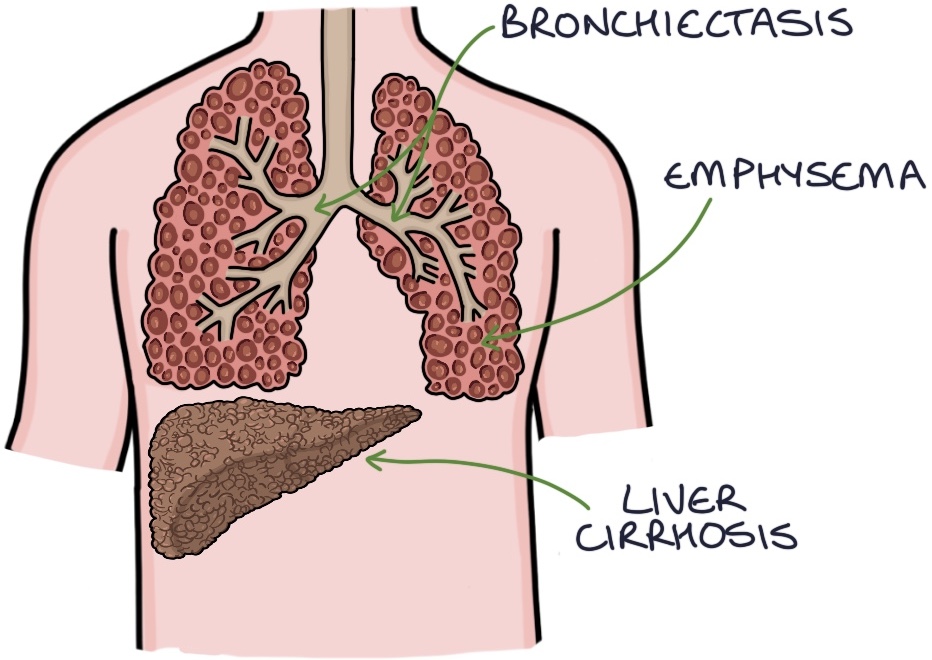 Alpha-1 Antitrypsin Deficiency – Zero To Finals