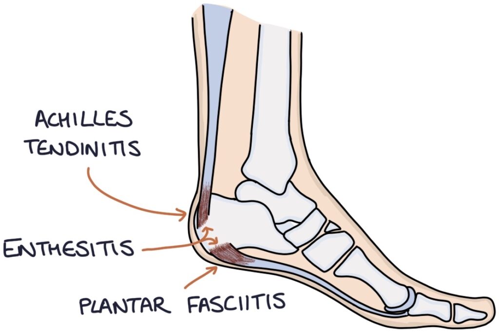 Ankylosing Spondylitis – Zero To Finals