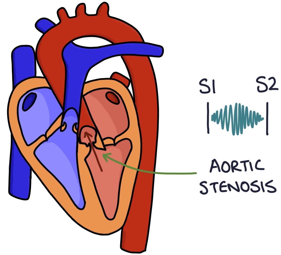 Aortic stenosis