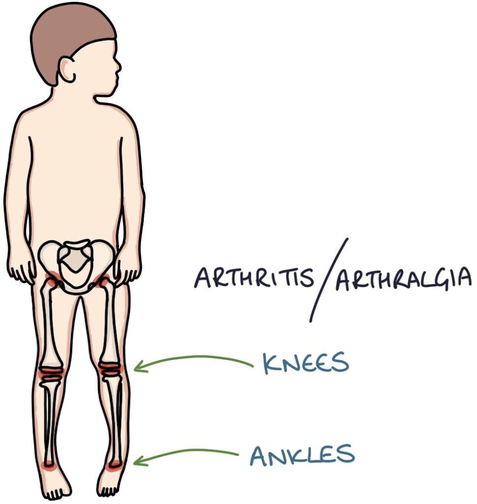 Henoch-Schonlein Purpura – Zero To Finals