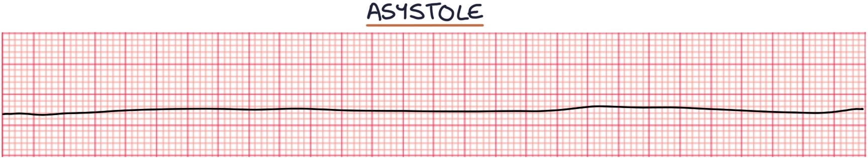 Arrhythmias – Zero To Finals