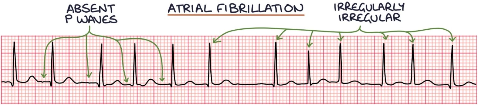 Atrial Fibrillation – Zero To Finals