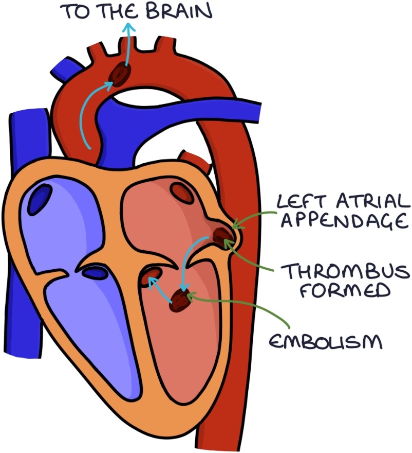 Atrial Fibrillation – Zero To Finals