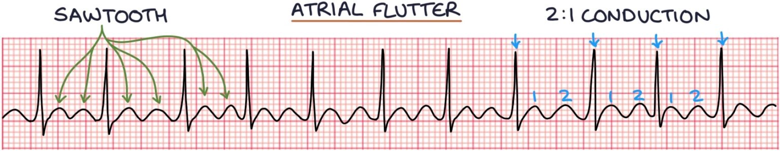 Supraventricular Tachycardia – Zero To Finals
