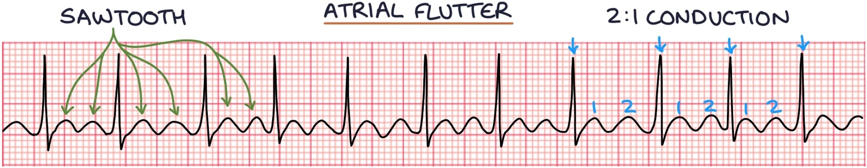 Supraventricular Tachycardia – Zero To Finals