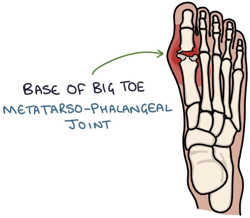 Gout – Zero To Finals