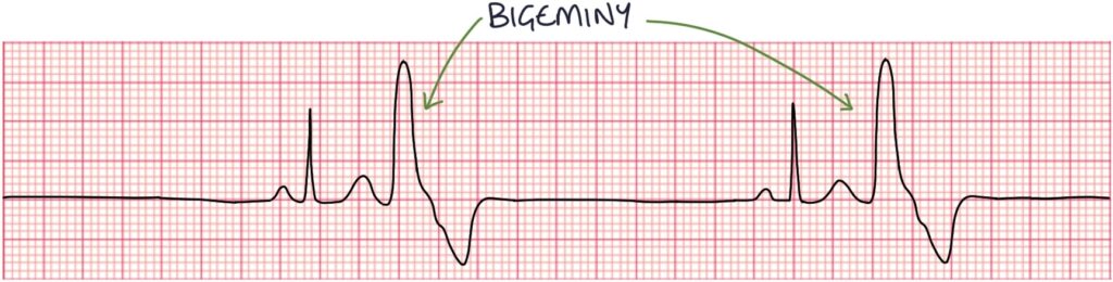 Arrhythmias – Zero To Finals