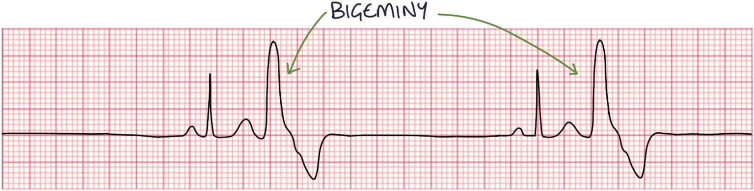 Arrhythmias – Zero To Finals