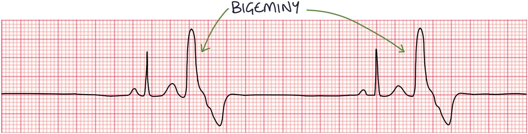 Arrhythmias – Zero To Finals
