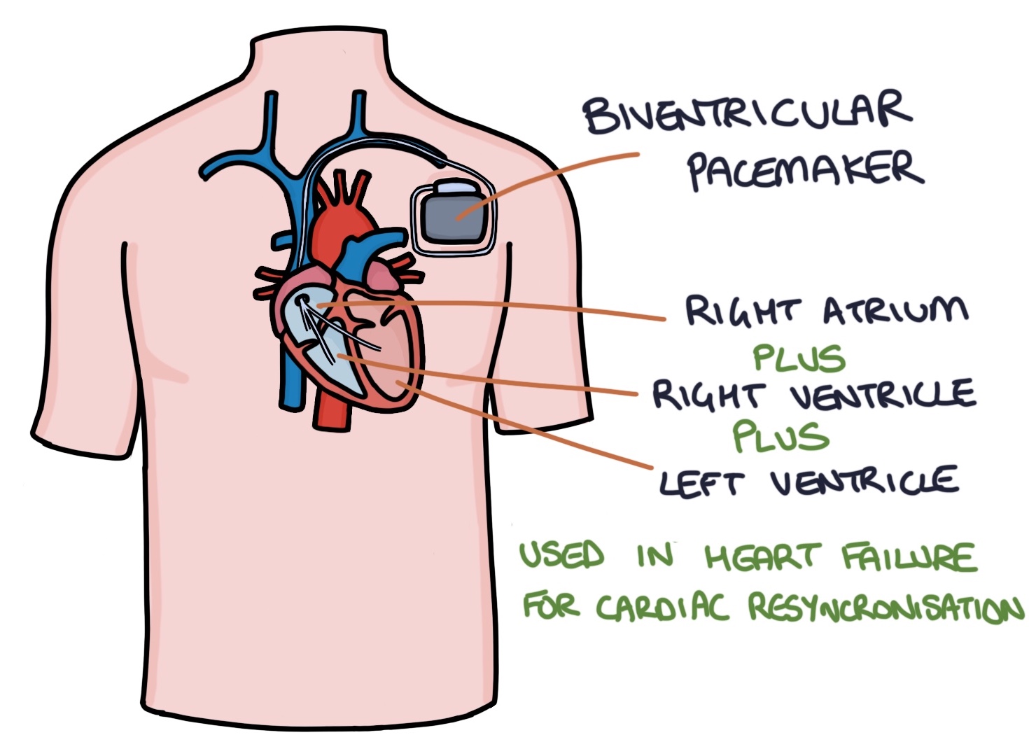 Pacemakers – Zero To Finals