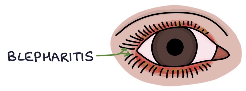Eyelid Disorders – Zero To Finals