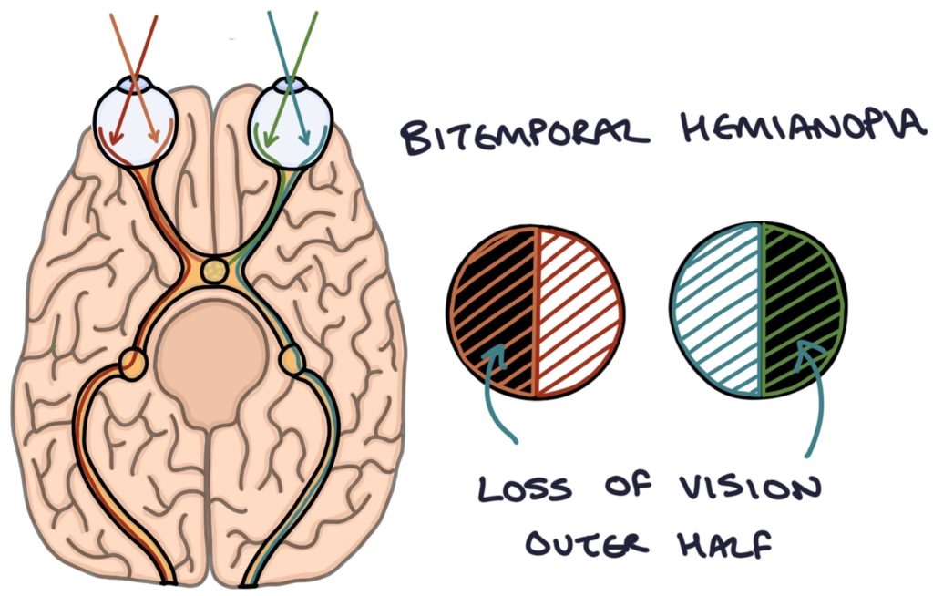 Acromegaly – Zero To Finals