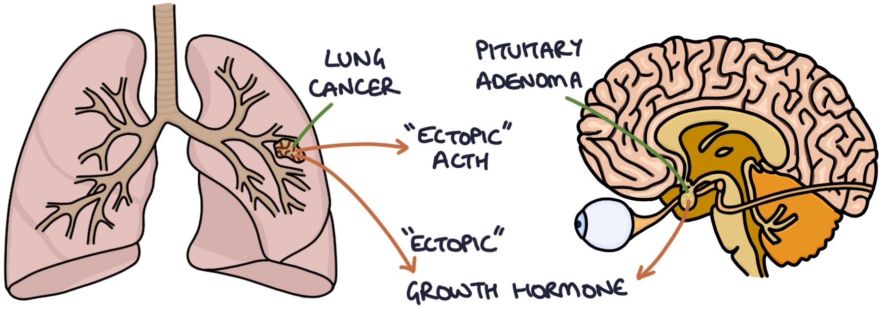 Acromegaly – Zero To Finals