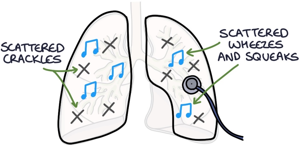 Bronchiectasis – Zero To Finals