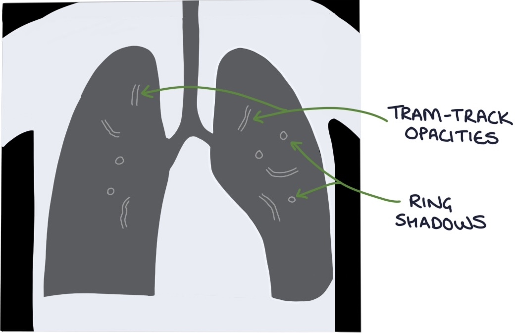Bronchiectasis – Zero To Finals