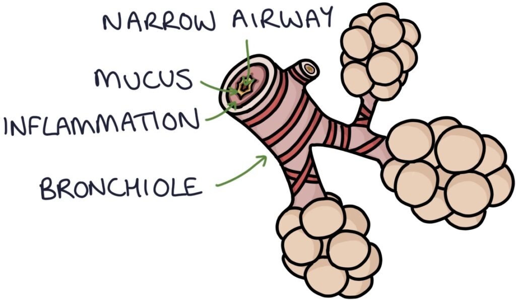 Bronchiolitis – Zero To Finals