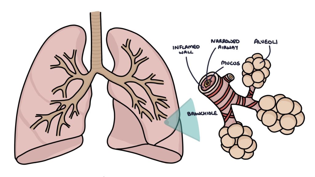 Bronchiolitis – Zero To Finals