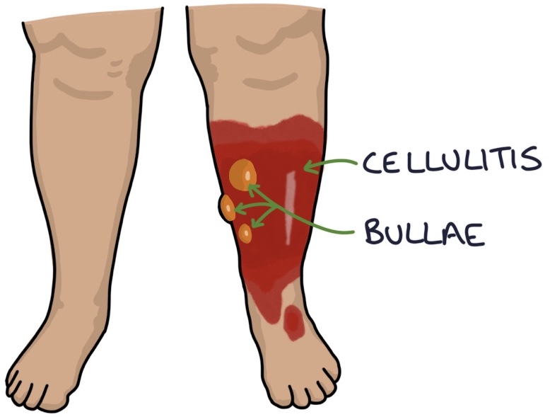 Skin and Soft Tissue Infections – Zero To Finals