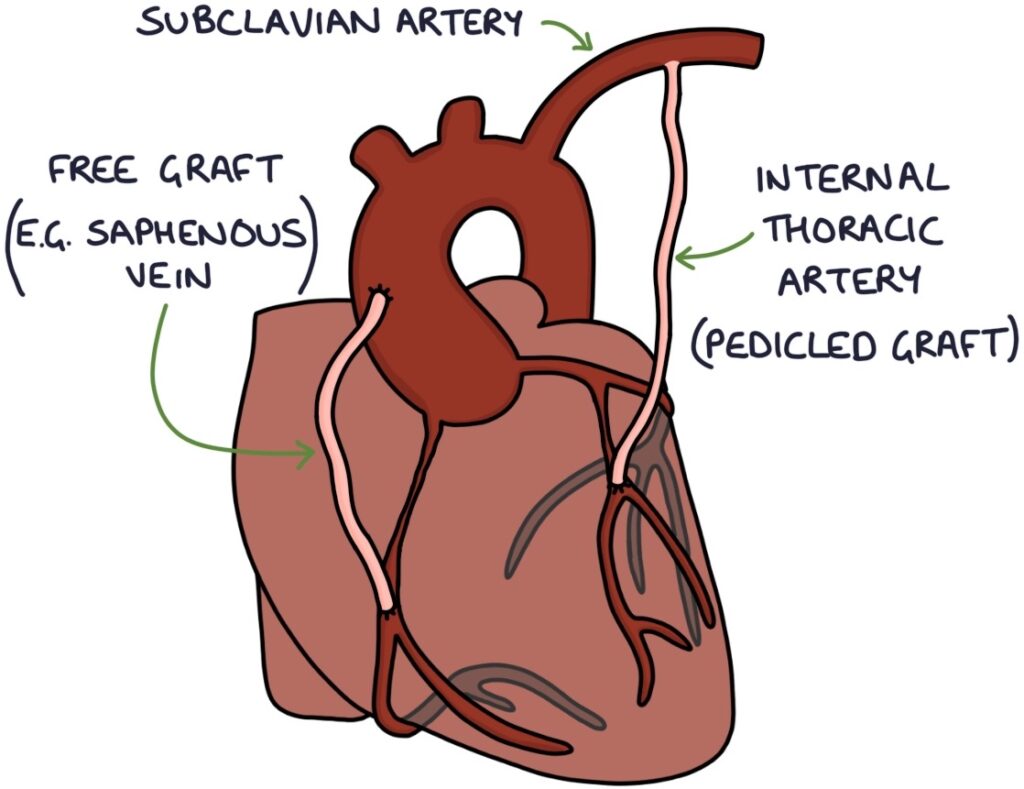 Coronary Artery Bypass Graft – Zero To Finals
