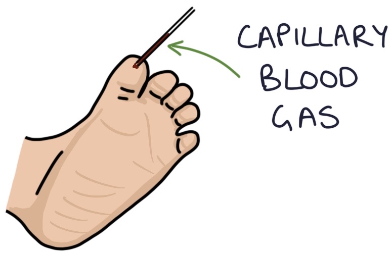Bronchiolitis – Zero To Finals