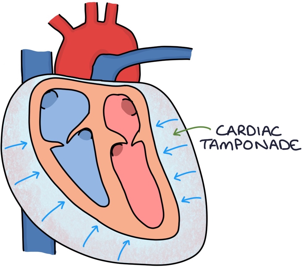 Pericarditis – Zero To Finals