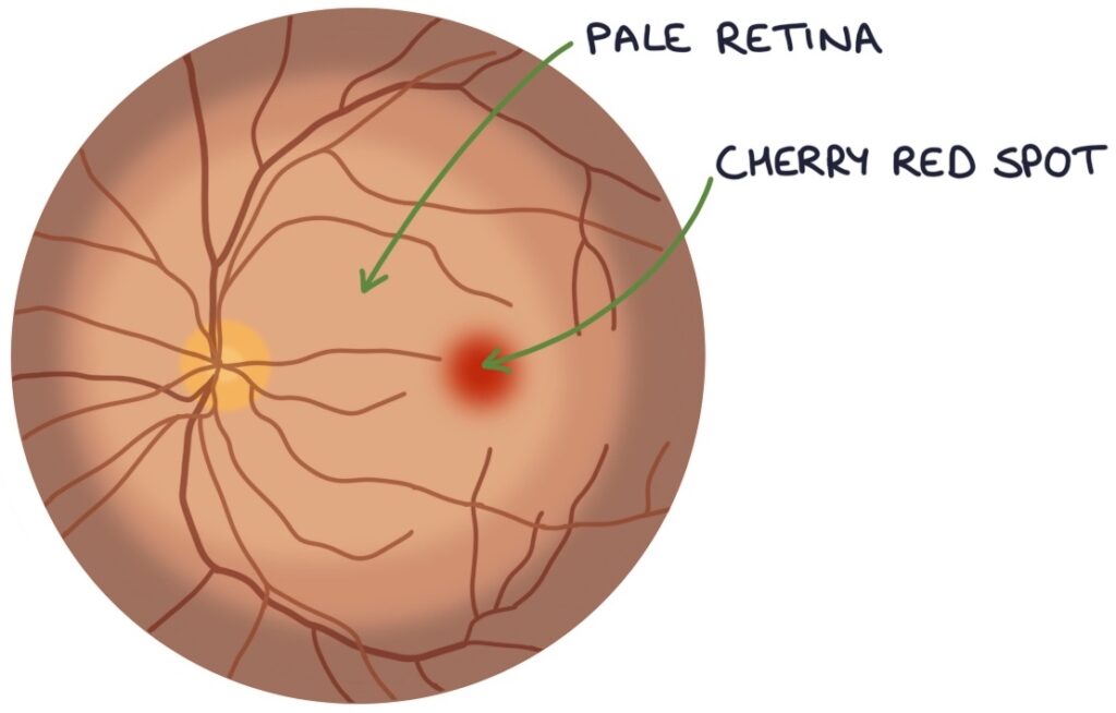 Central Retinal Artery Occlusion – Zero To Finals