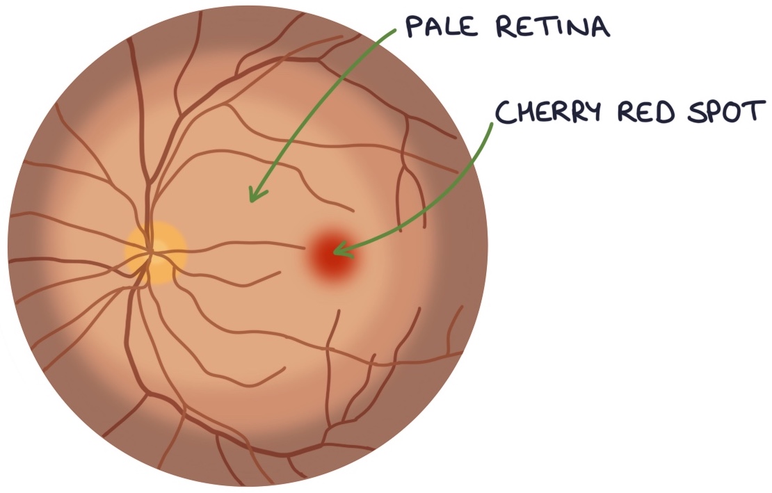 Central Retinal Artery Occlusion – Zero To Finals