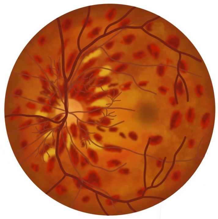 Retinal Vein Occlusion – Zero To Finals