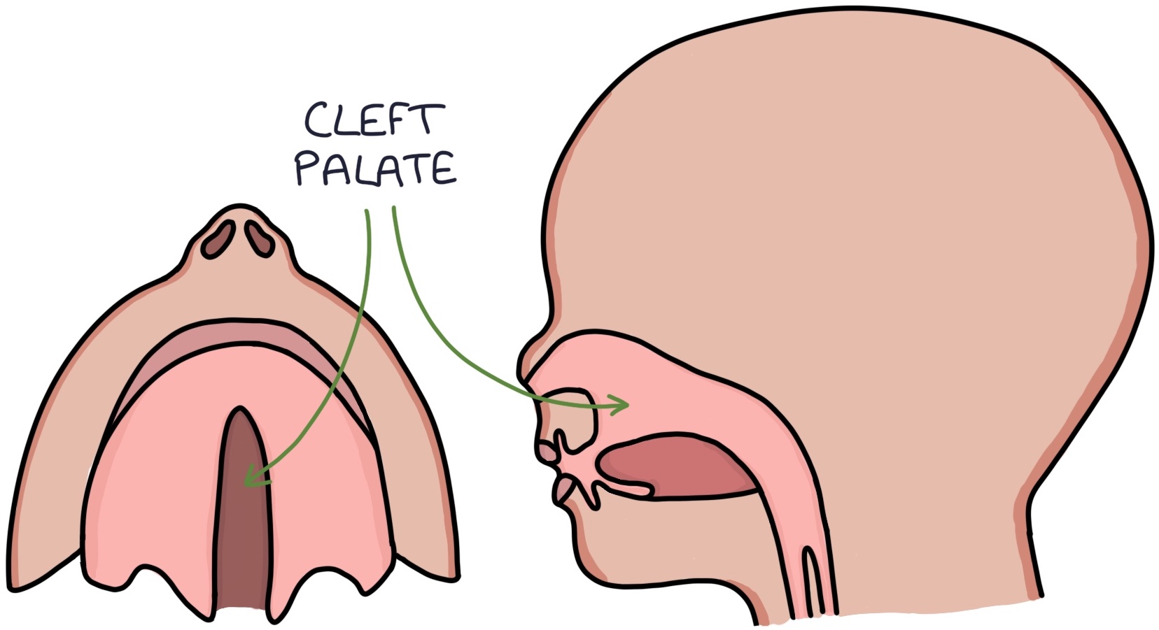 Cleft Lip – Zero To Finals