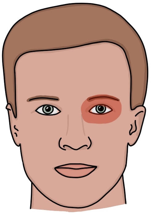 Cluster headaches – Zero To Finals