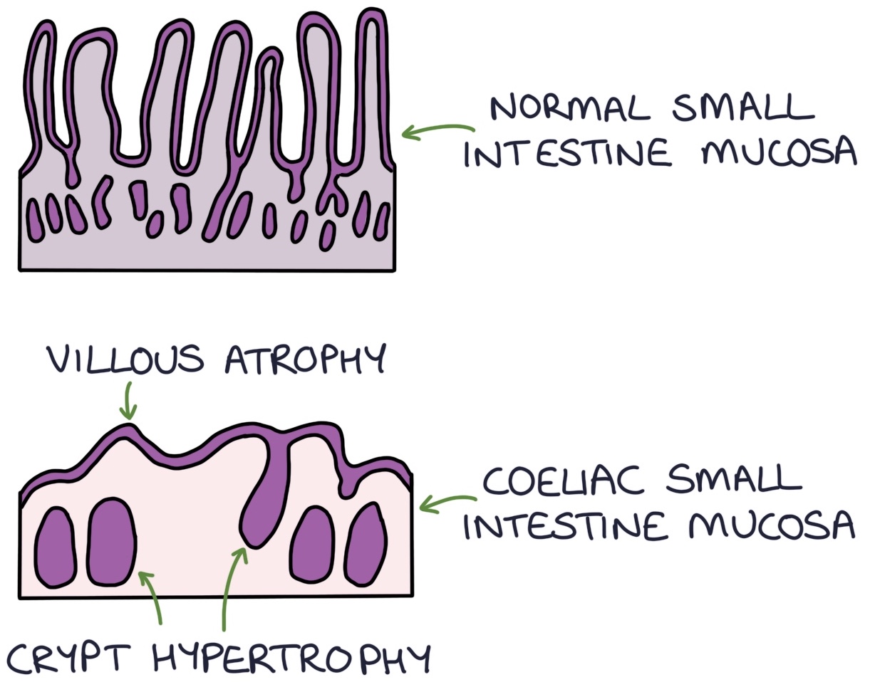 Coeliac Disease – Zero To Finals