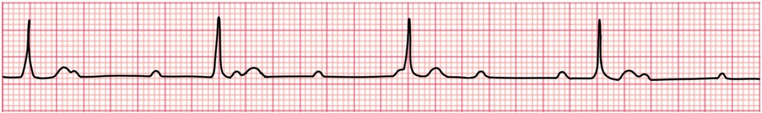 Arrhythmias – Zero To Finals