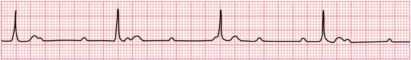 Arrhythmias – Zero To Finals