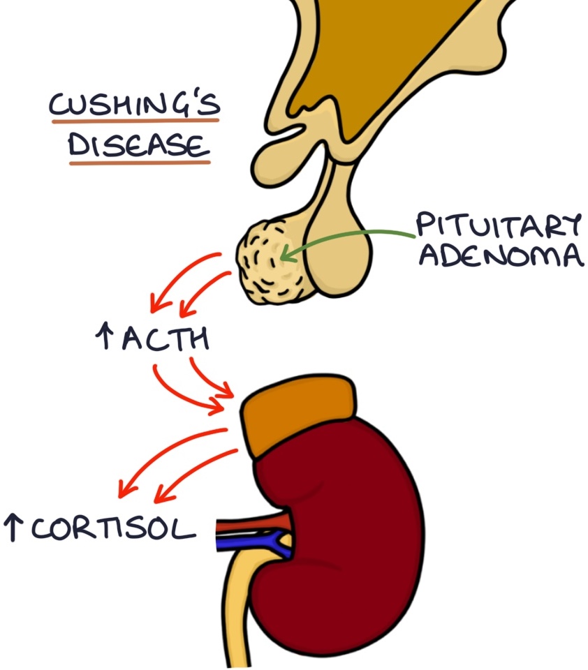 Cushing’s Syndrome – Zero To Finals