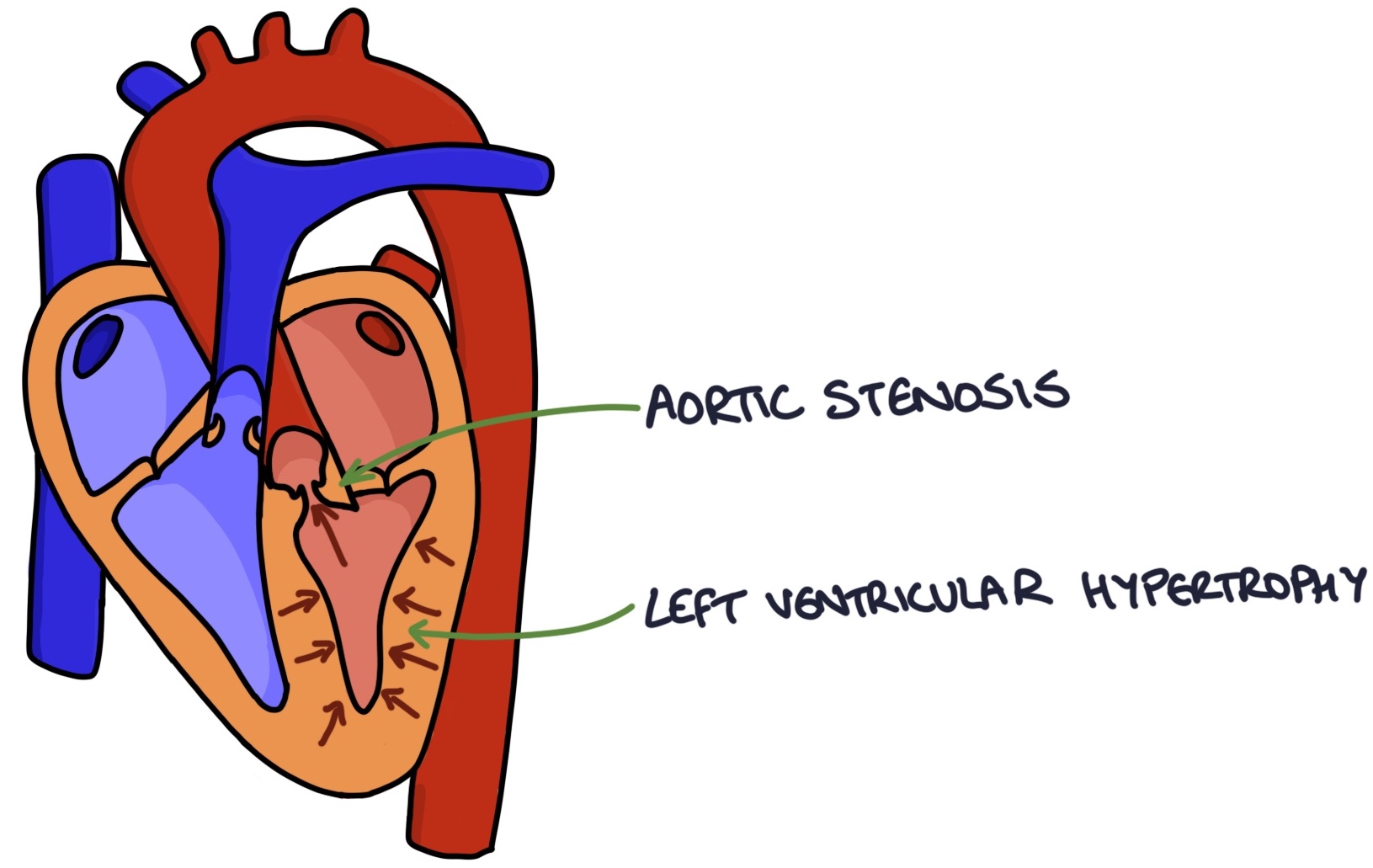 Valvular Heart Disease – Zero To Finals