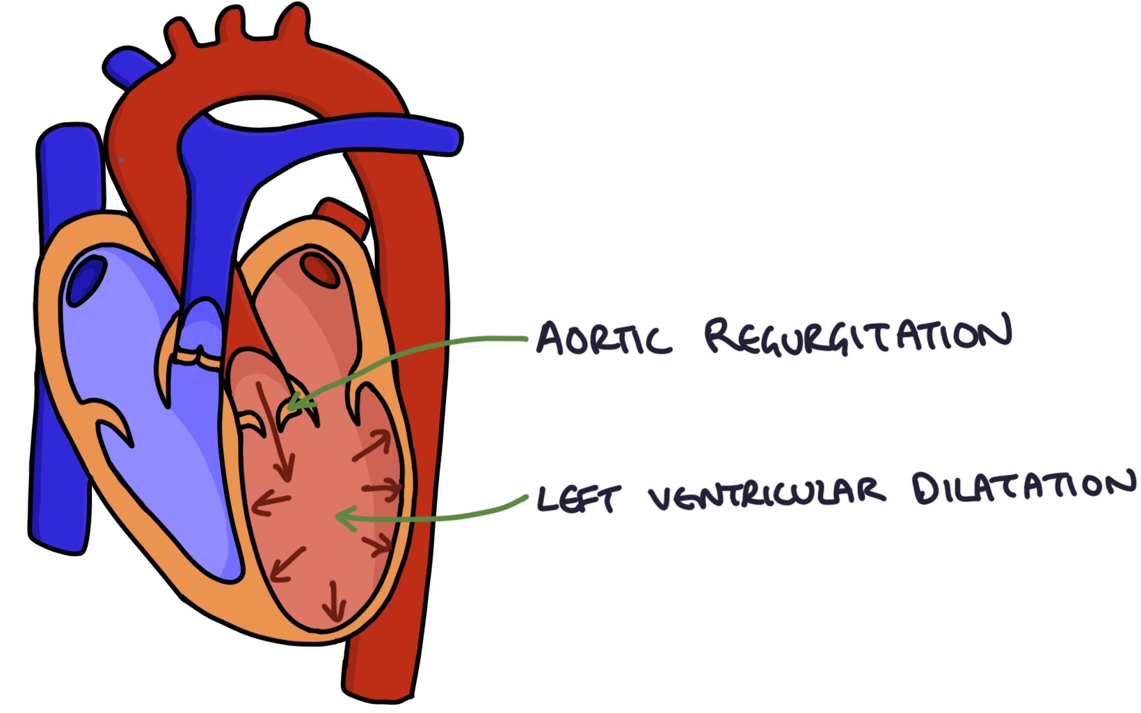 Valvular Heart Disease – Zero To Finals