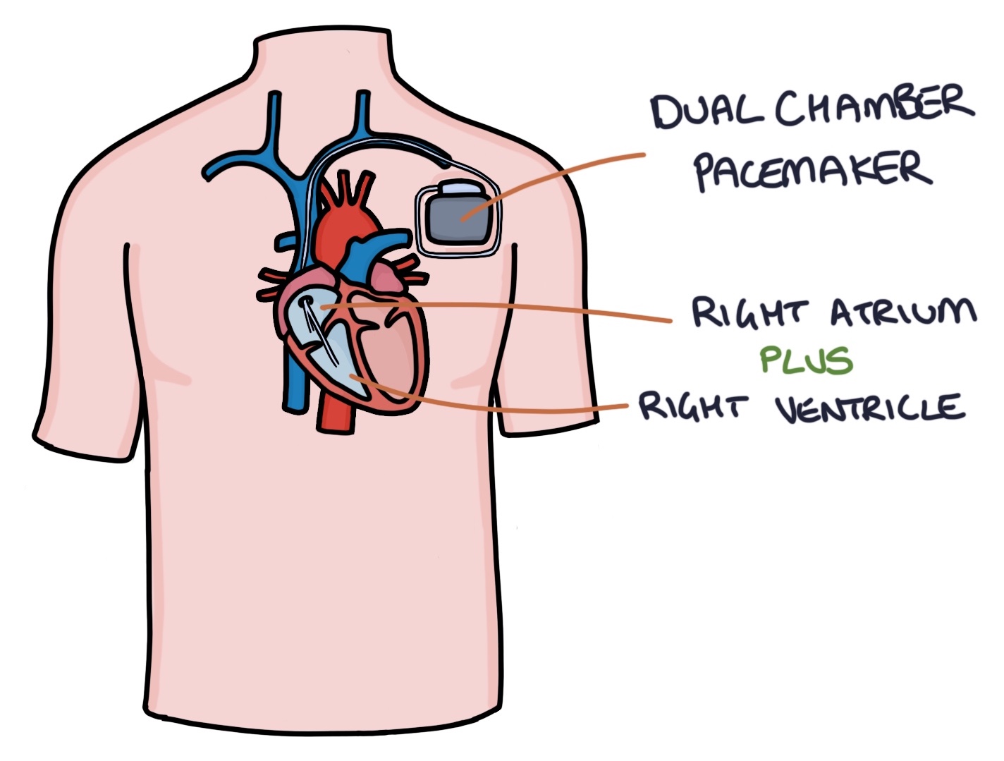 Pacemakers – Zero To Finals