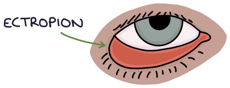 Eyelid Disorders – Zero To Finals