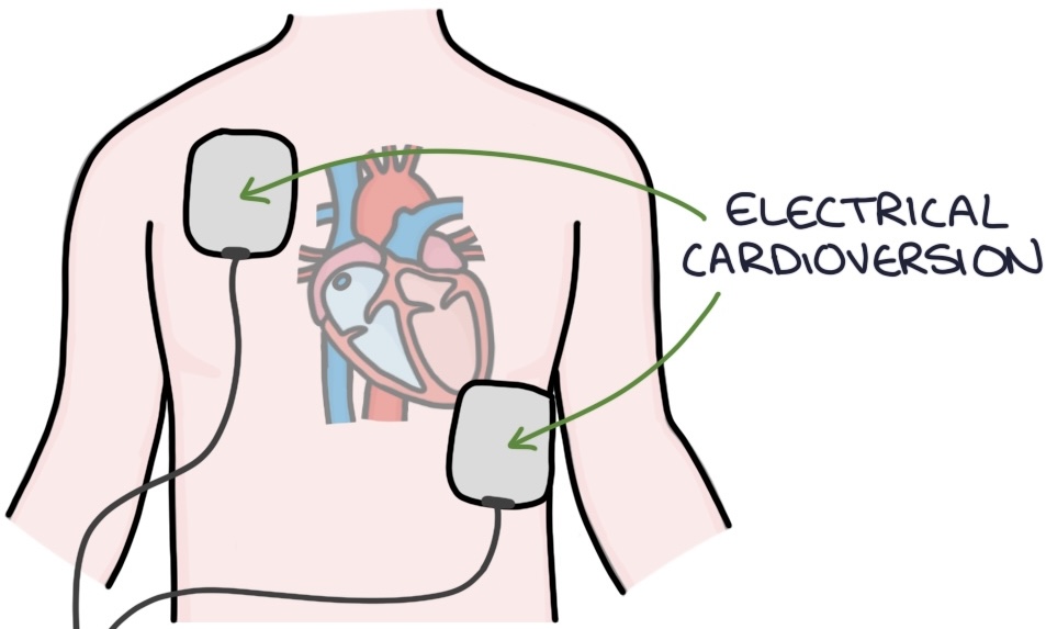 Atrial Fibrillation – Zero To Finals