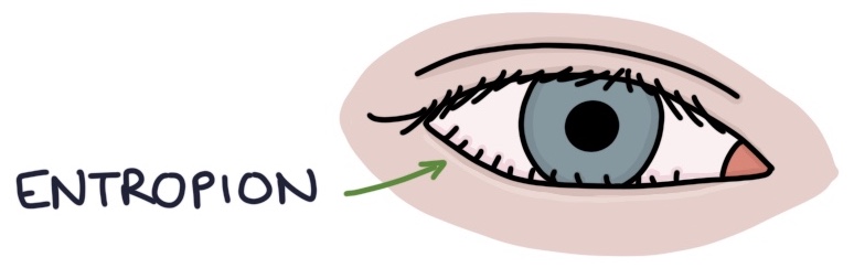 Eyelid Disorders – Zero To Finals