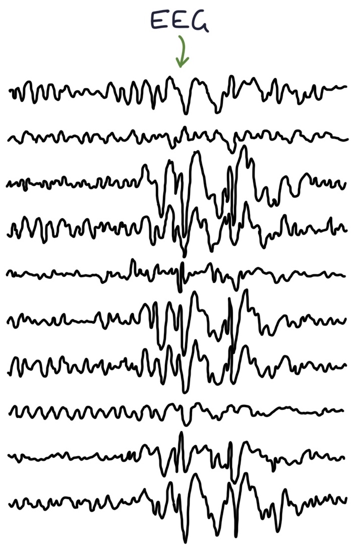 Epilepsy – Zero To Finals