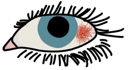 Episcleritis – Zero To Finals