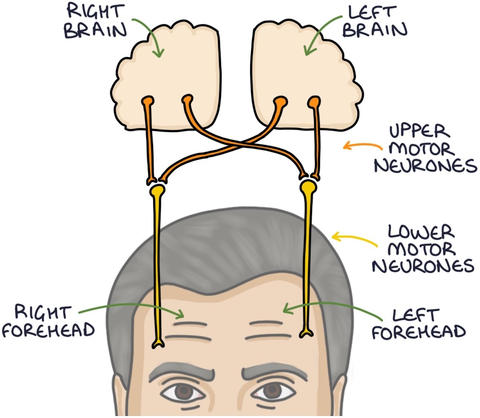 Facial Nerve Palsy – Zero To Finals