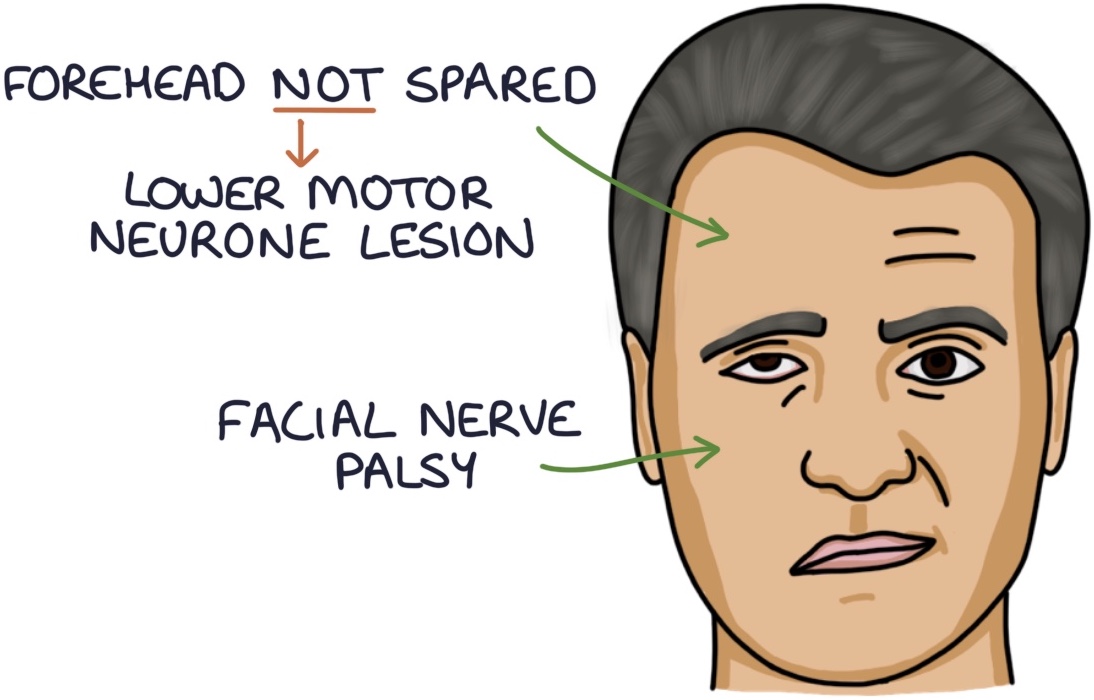 Acoustic Neuroma – Zero To Finals