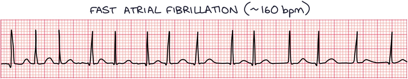 Atrial Fibrillation – Zero To Finals